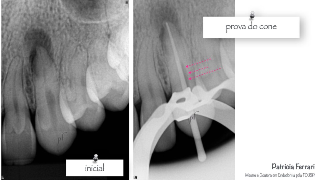 Canal calcificado em canino superior • Patricia Ferrari Endodontia