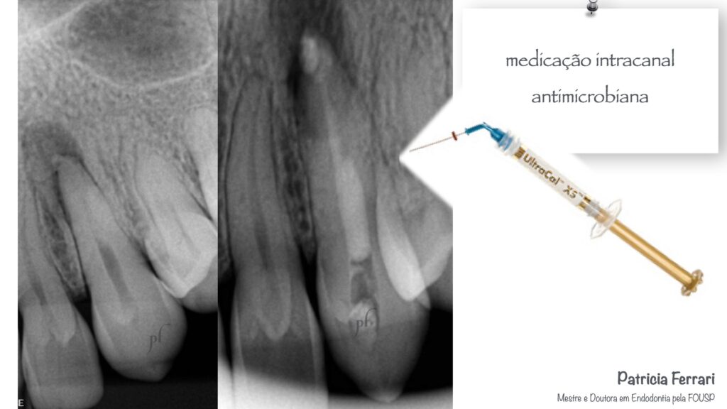Canal calcificado em canino superior • Patricia Ferrari Endodontia