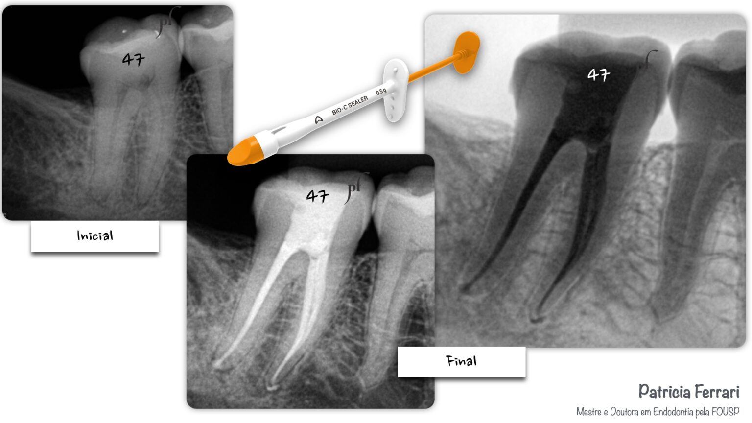 Pulpite Irreversivel em molar inferior • Patricia Ferrari Endodontia