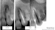Canal calcificado em canino superior • Patricia Ferrari Endodontia