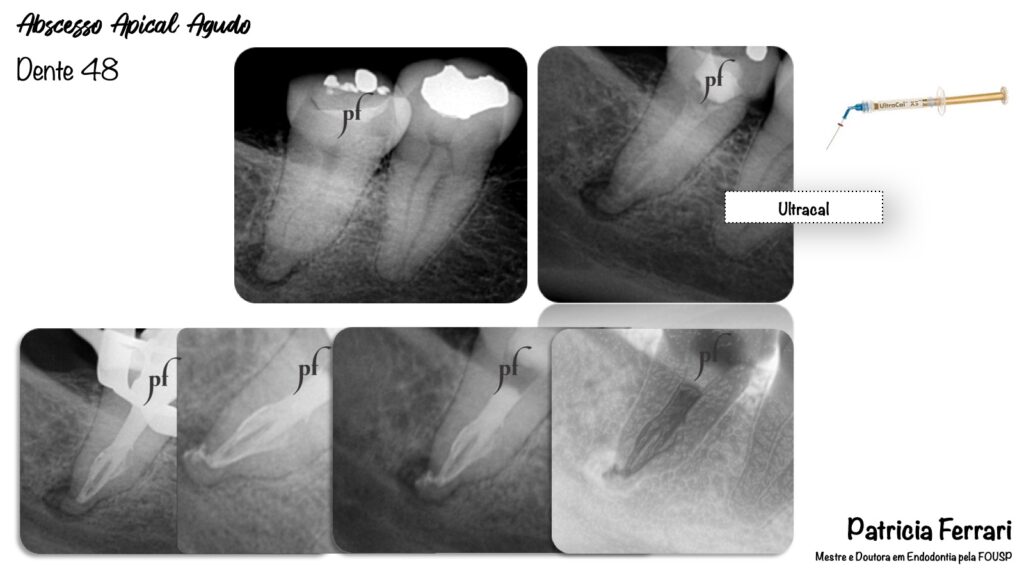 Abscesso Periapical Agudo em dente 48 • Patricia Ferrari Endodontia