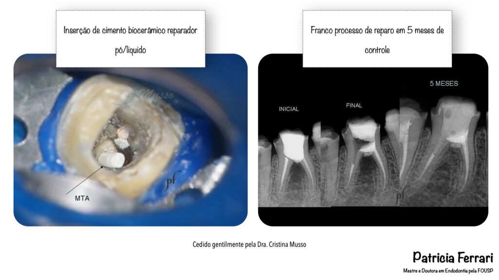Perfuração Radicular • Patricia Ferrari Endodontia