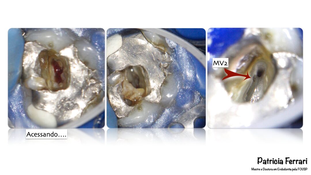 Pulpite Irreversível em molar superior • Patricia Ferrari Endodontia