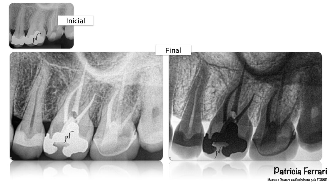 Pulpite Irreversível em molar superior • Patricia Ferrari Endodontia