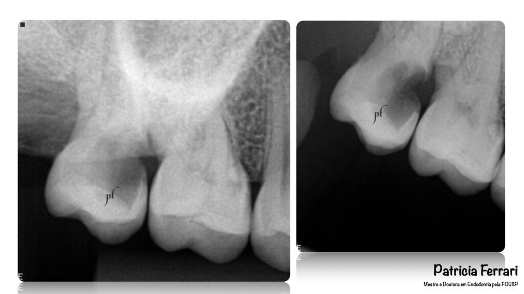 Dente 17 com Periodontite Apical Primária • Patricia Ferrari Endodontia